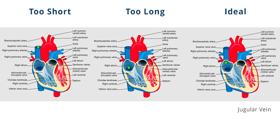 Catheter Tip Location and its Impact on Patency